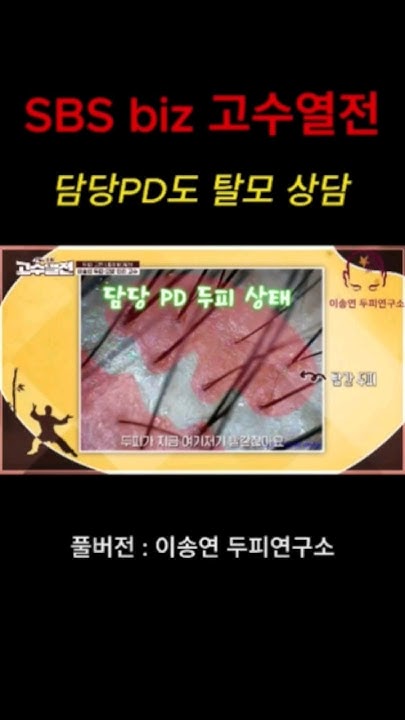 (SBS biz 고수열전) 담당PD도 두피 상담!!! #shorts - YouTube