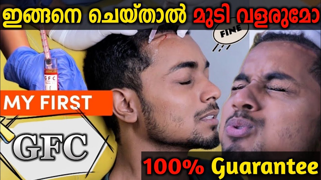 GFC Results Before and After | ഇനി നിങ്ങളുടെ Hair കൊഴിയില്ല💯 | GFC Treatment - YouTube