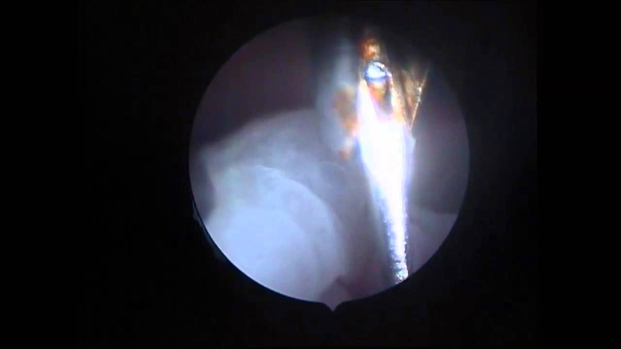 Hysteroscopic removal of multiple endometrial polyps - YouTube