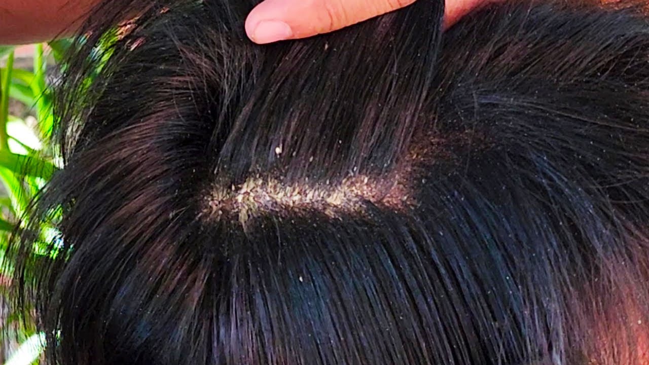 ASMR Scalp Scratching for Sleep and Relaxing Care #439 - YouTube