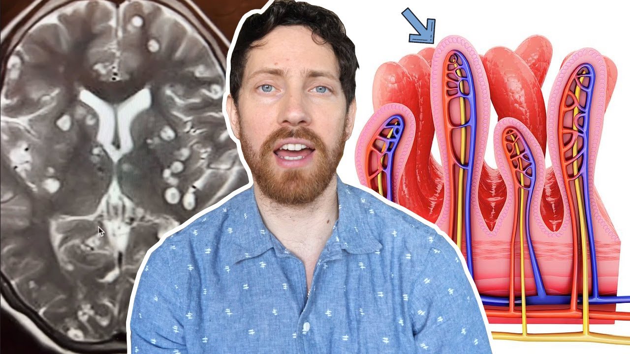 At 28 Years Old His Brain Was Filled with Holes. Here's Why. - YouTube