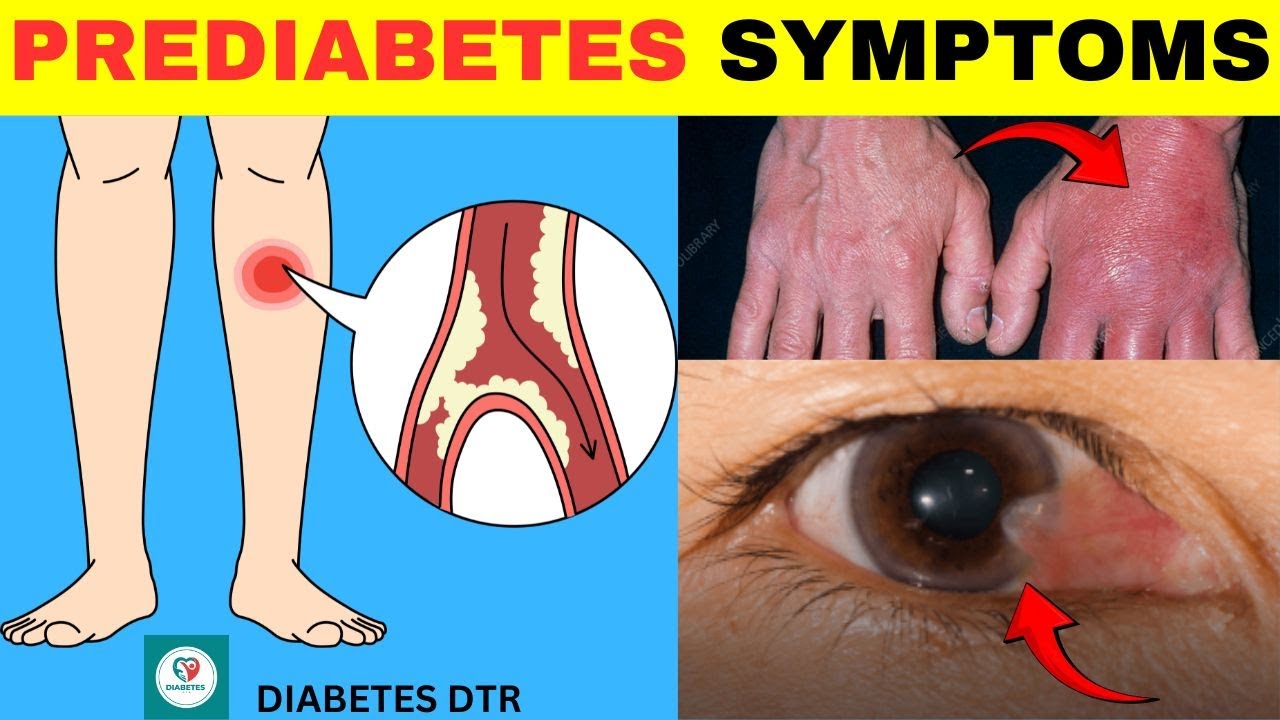 10 Early Warning Signs of Prediabetes You Shouldn’t Ignore - YouTube
