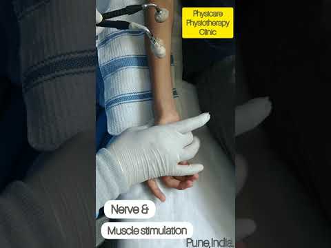 HIRAYAMA DISEASE Nerve and Muscles Stimulation