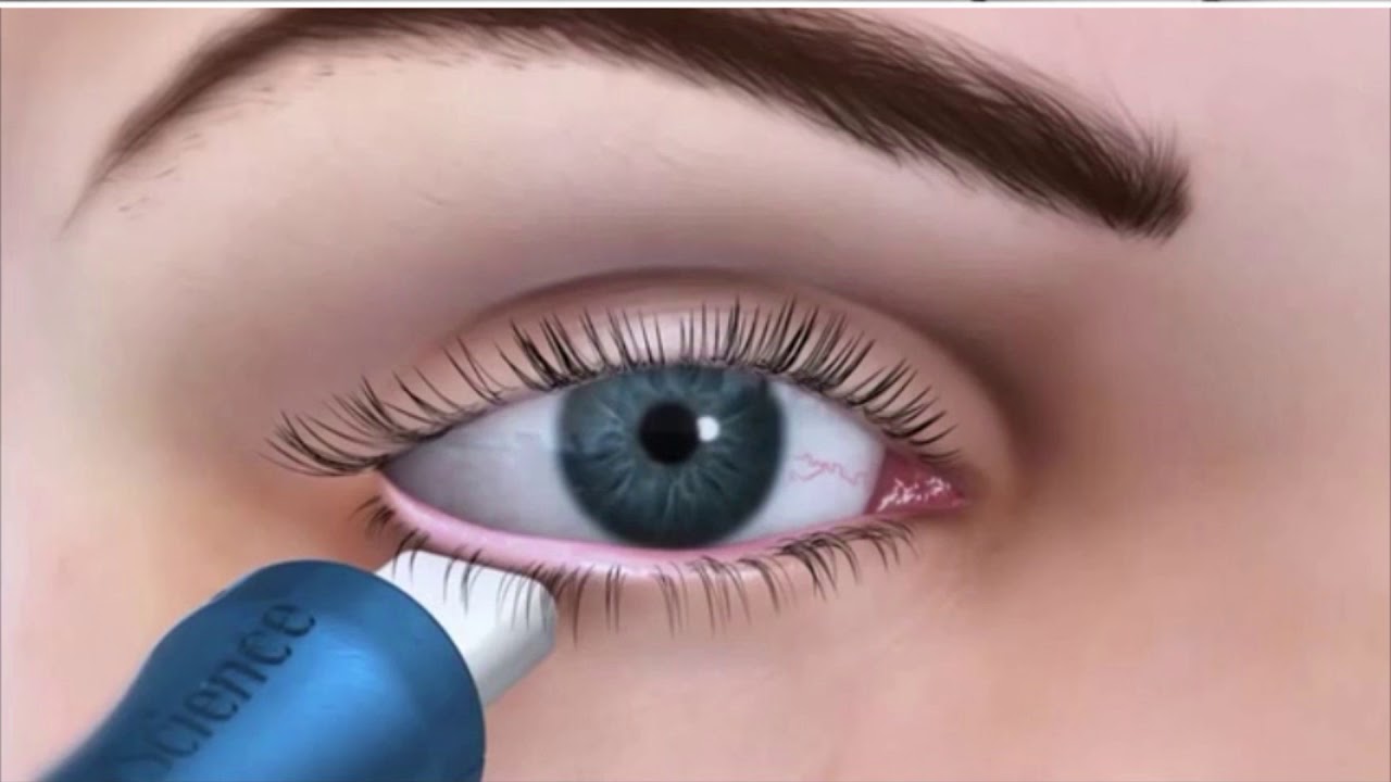 Meibomitis por Belén Pimentel - YouTube