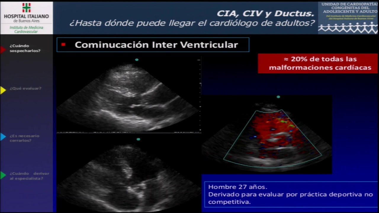 CIA, CIV y Ductus ¿Hasta dónde puede llegar el cardiólogo de adultos? - YouTube