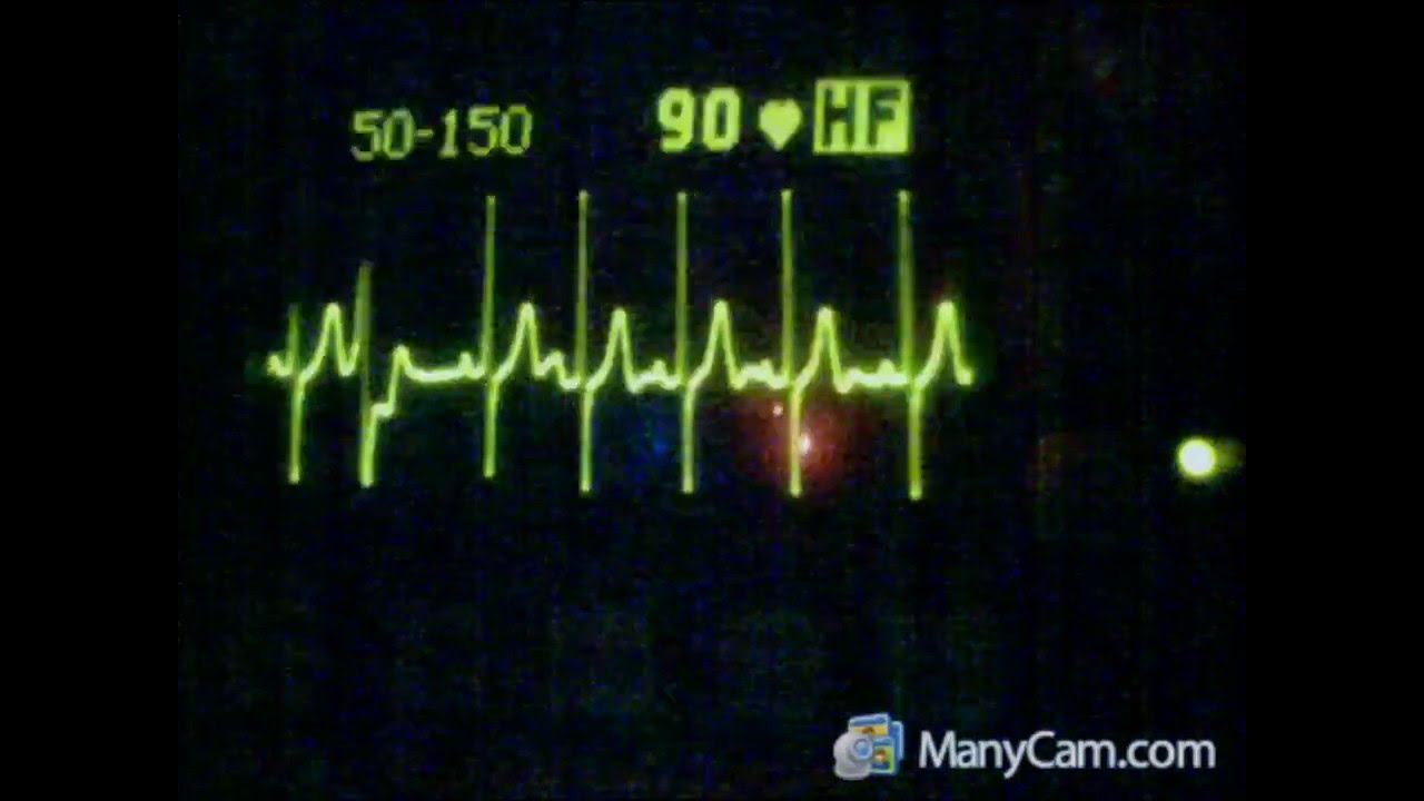 Heartbeat with weed and breathhold - YouTube