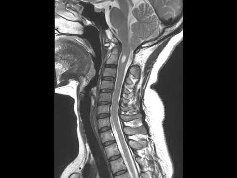 Spinal Cord Syrinx
