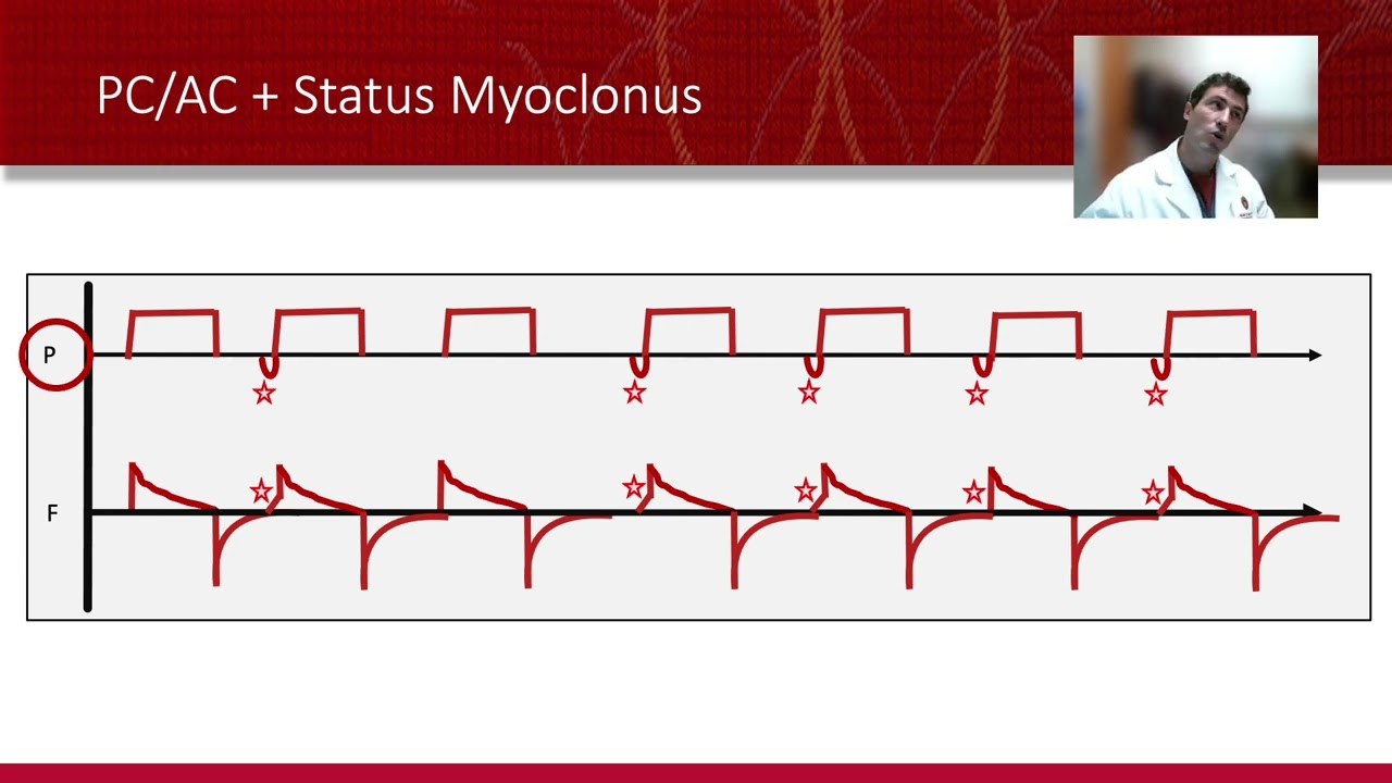 Ventilator Case: Status Myoclonus - YouTube