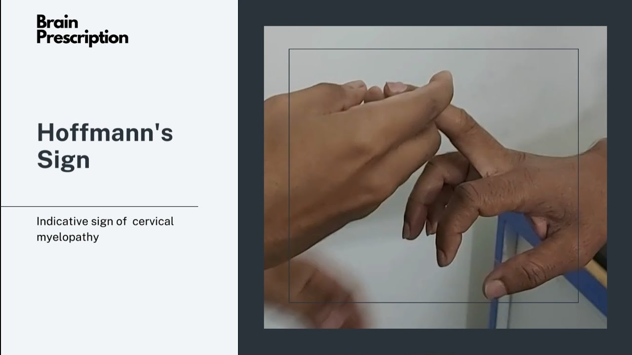 Hoffmann sign- know how to elicit this and never forget the cigarette ...