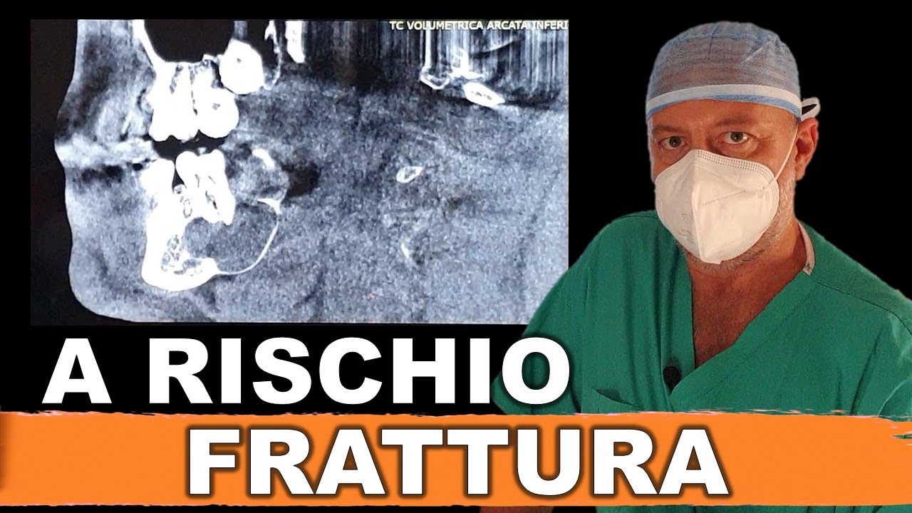 Abbiamo rischiato una FRATTURA di mandibola per una CISTI - YouTube