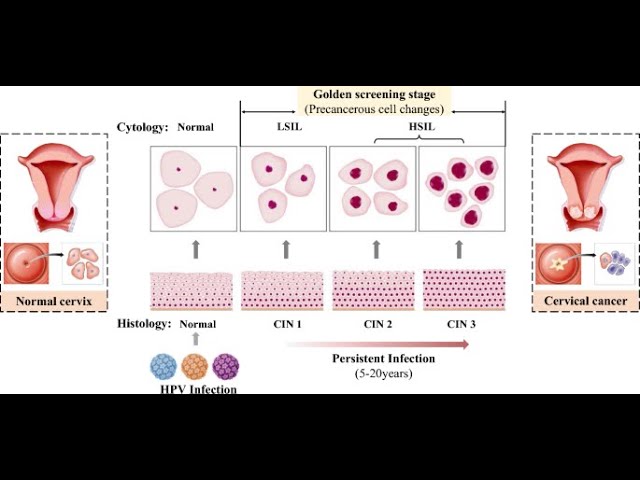 Cervical Cancer Cell Changes