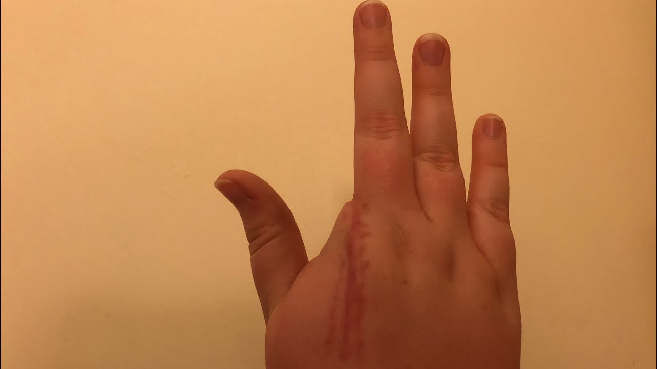 Questions About My Amputated Finger YouTube