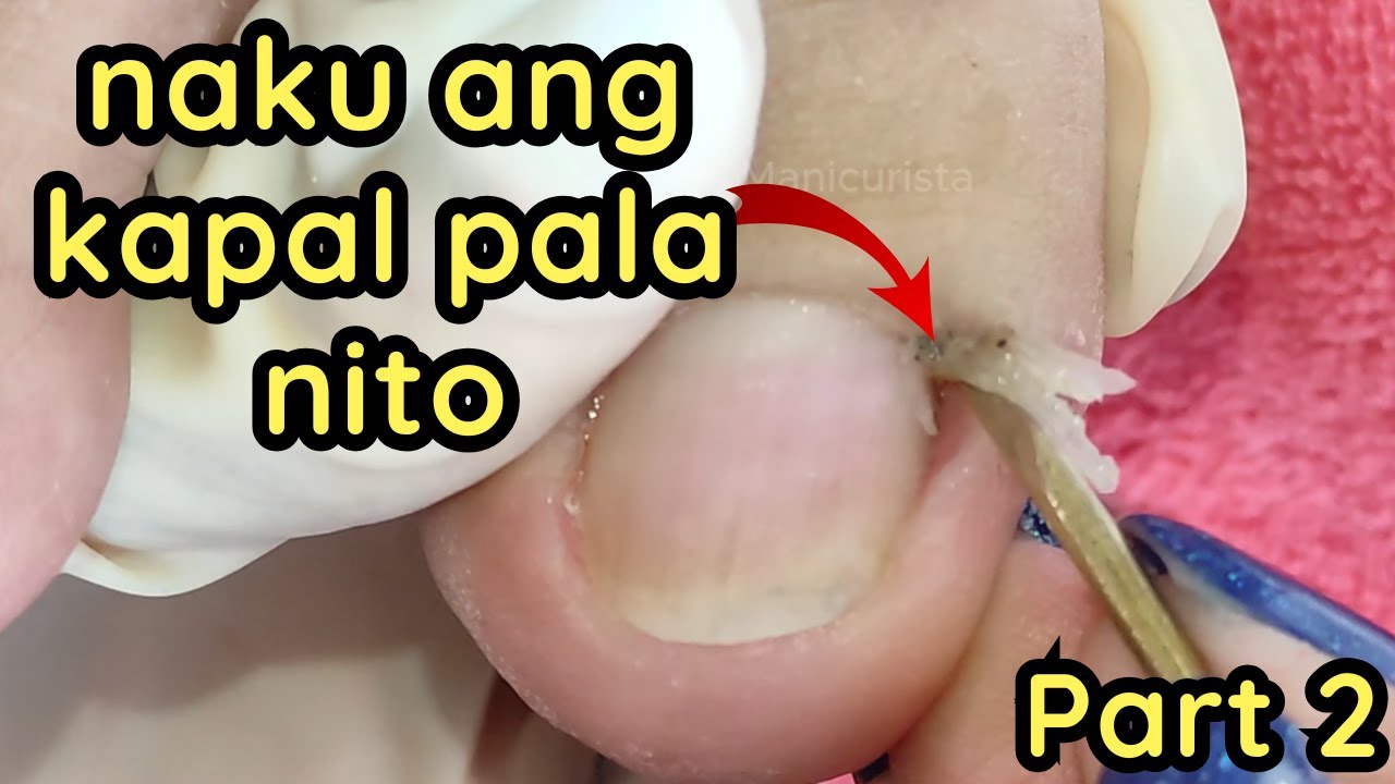Part 2| Makapal na madaming dry skin sa paa - YouTube