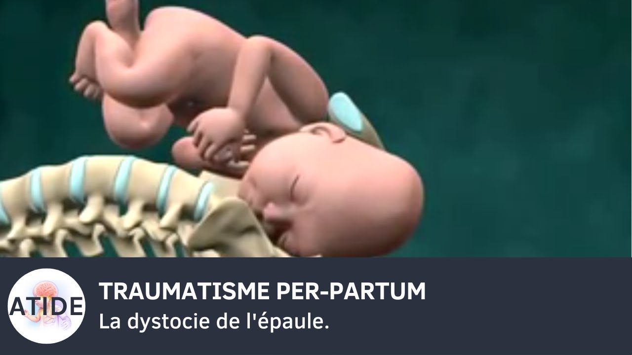 La dystocie de l'épaule. - YouTube