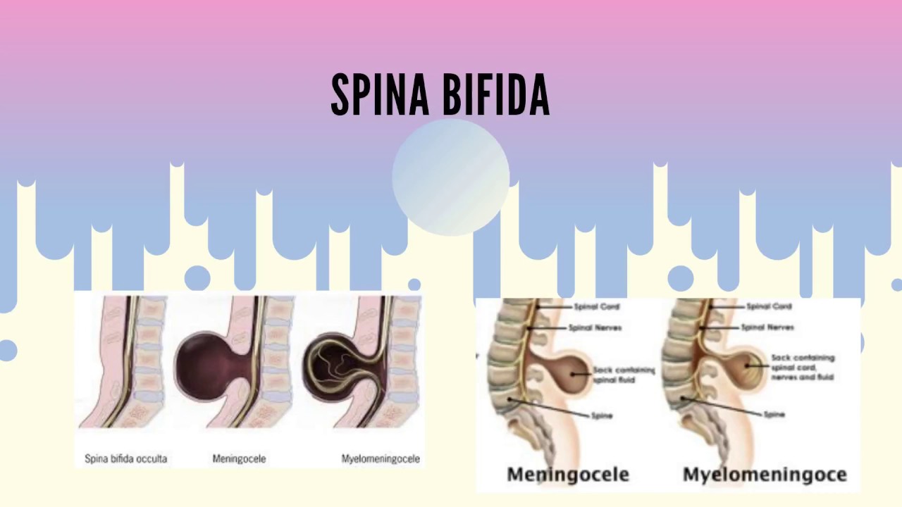 Spina Bifida/ Types of Spina Bifida - YouTube