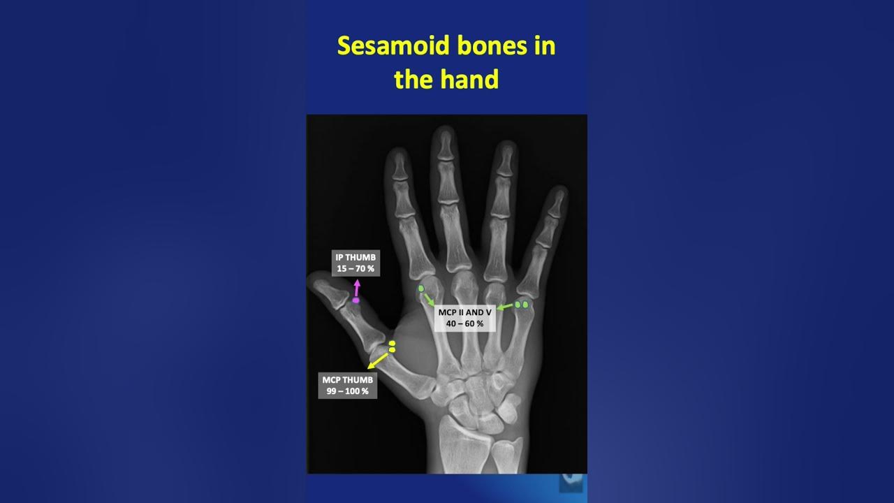 Shorts 57 Sesamoid Bones In The Hand Location Function And Significance In Less Than A