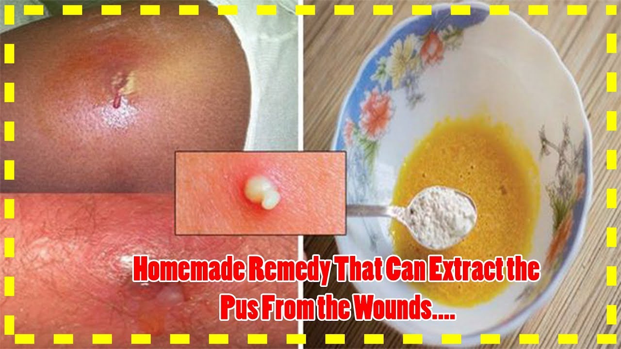 Homemade Remedy That Can Extract the Pus From the Wounds - YouTube