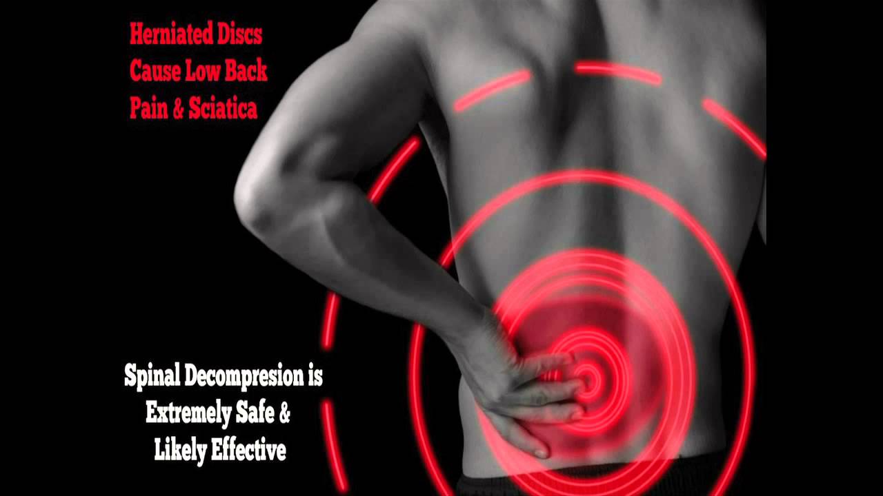 Acute Lumbar Herniated Disc Most Common Cause of Sciatica Austin - YouTube