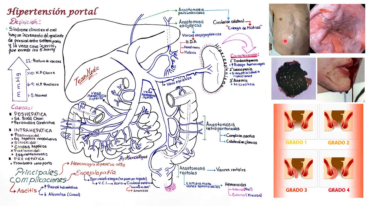 HIPERTENSIÓN PORTAL - YouTube