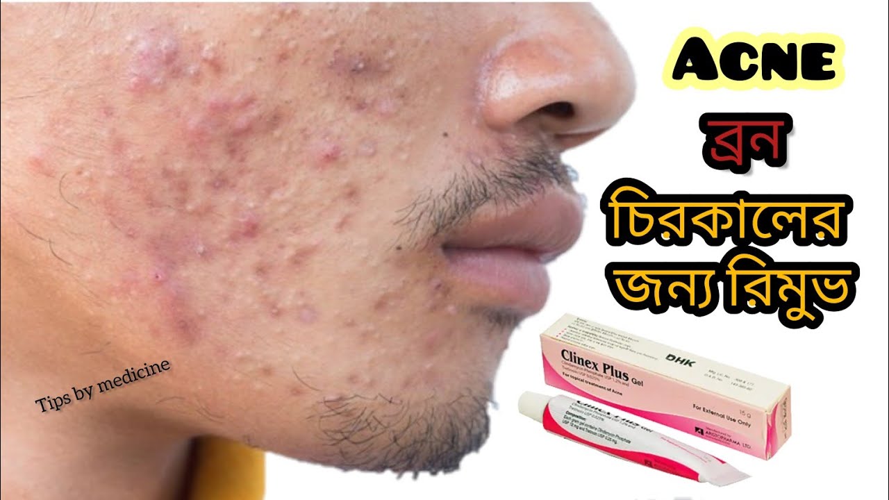 ব্রনের কালো দাগ ও ব্রন ভালো করার ভয়ংকর ক্রিম। Clinex plus gel. Health ...