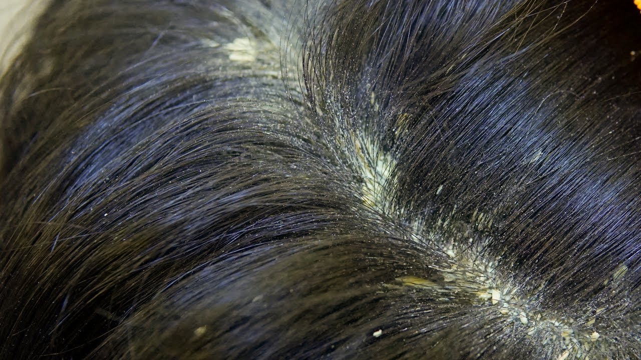 Dandruff Scratching Scalp Big Flakes Youtube