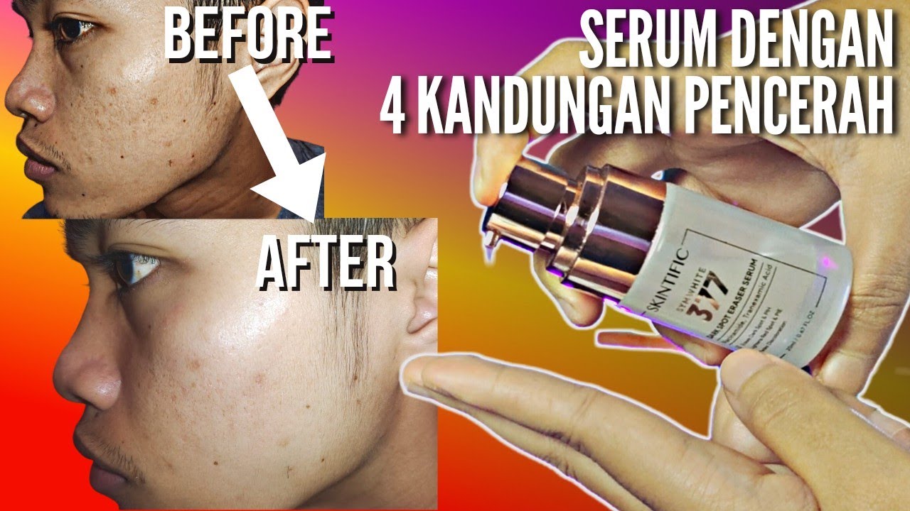 Cukup 1 Serum Flek Hitam Hilang Review Skintific SymWhite 377 2 Minggu ...