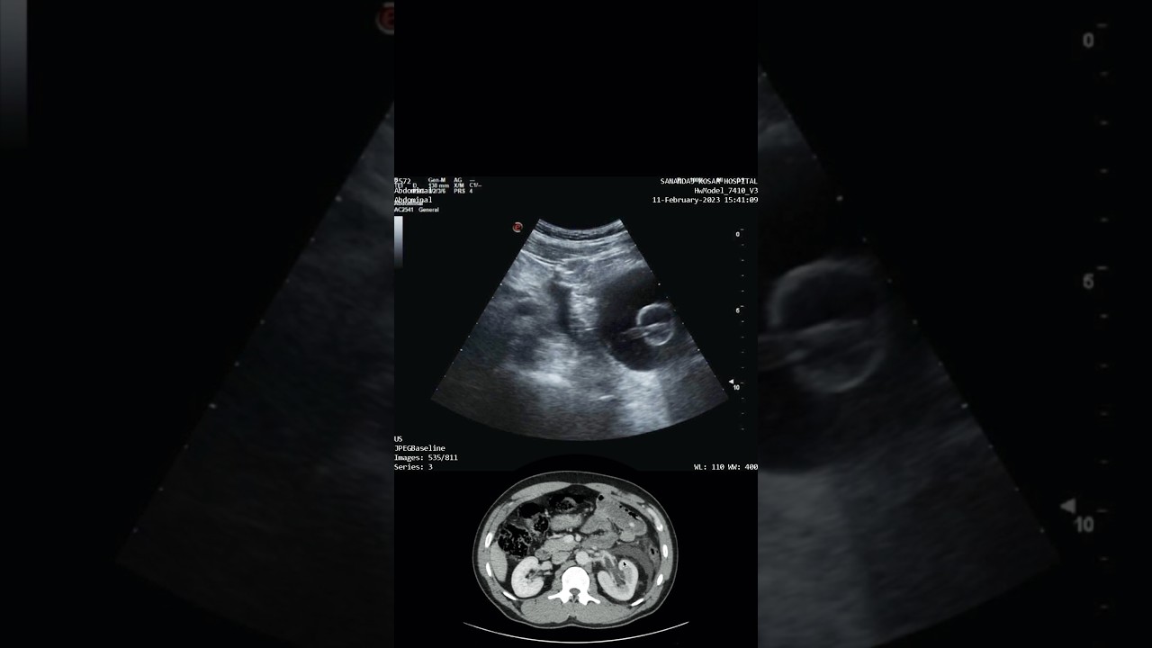 Emergency Medicine Examination: Detecting Urinoma and Renal Pelvic ...