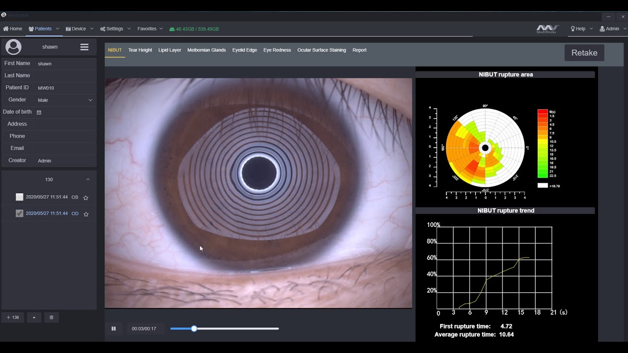 MediWorks Dry Eye Software-NIBUT Test Intro - YouTube