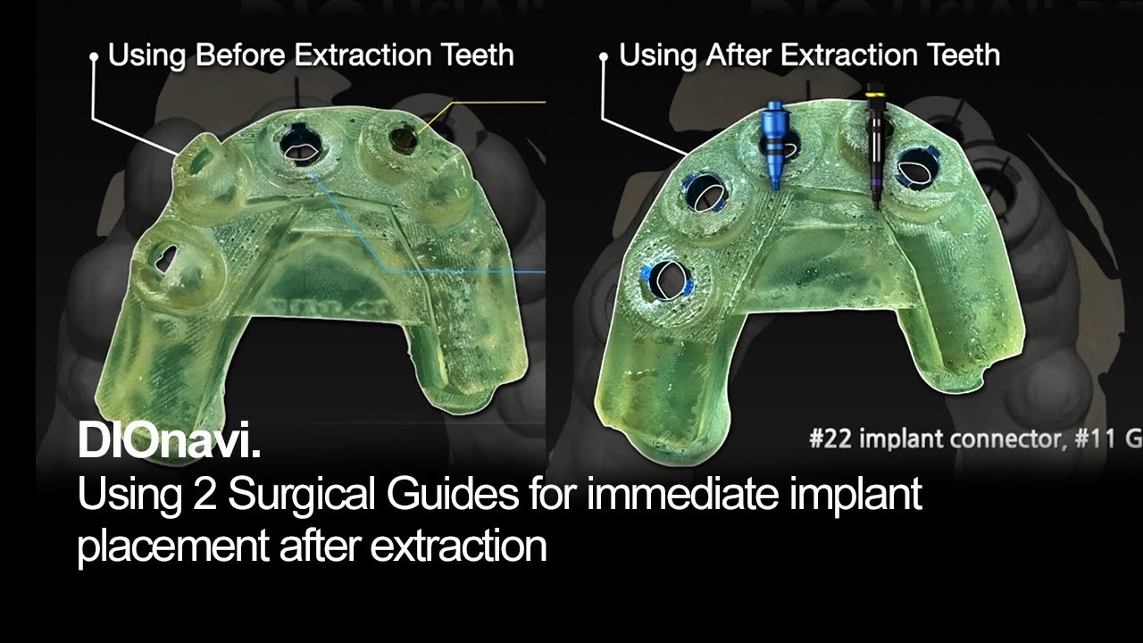 Using 2 Surgical Guides for immediate implant placement after ...