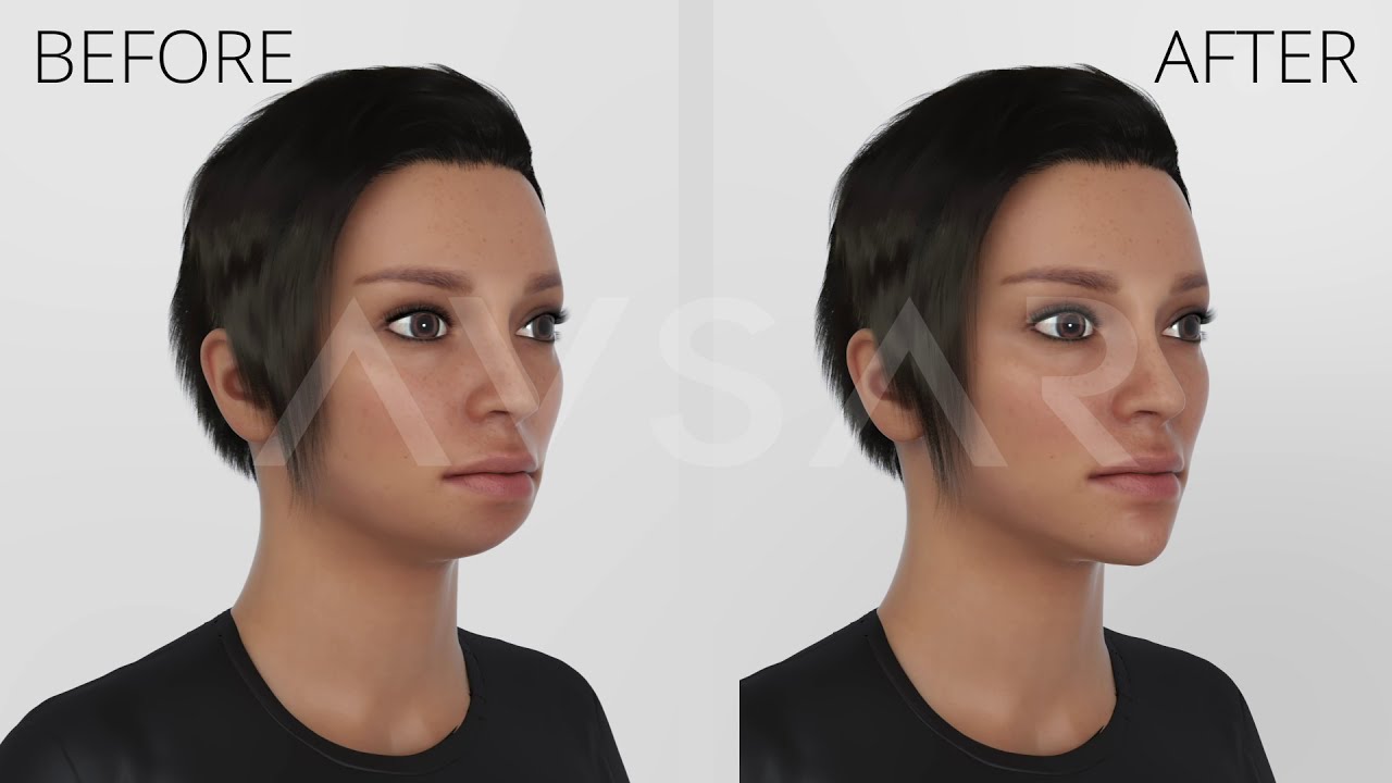 Dr. Yakup Avşar Chin Implant Surgery Istanbul Turkey - YouTube