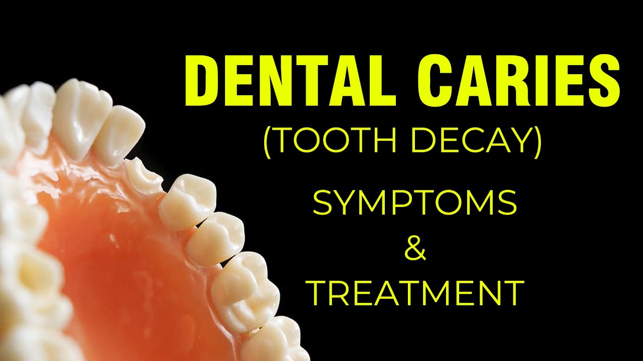 Dental Caries (Tooth Decay) | Symptoms | Treatment - Dental Clinic