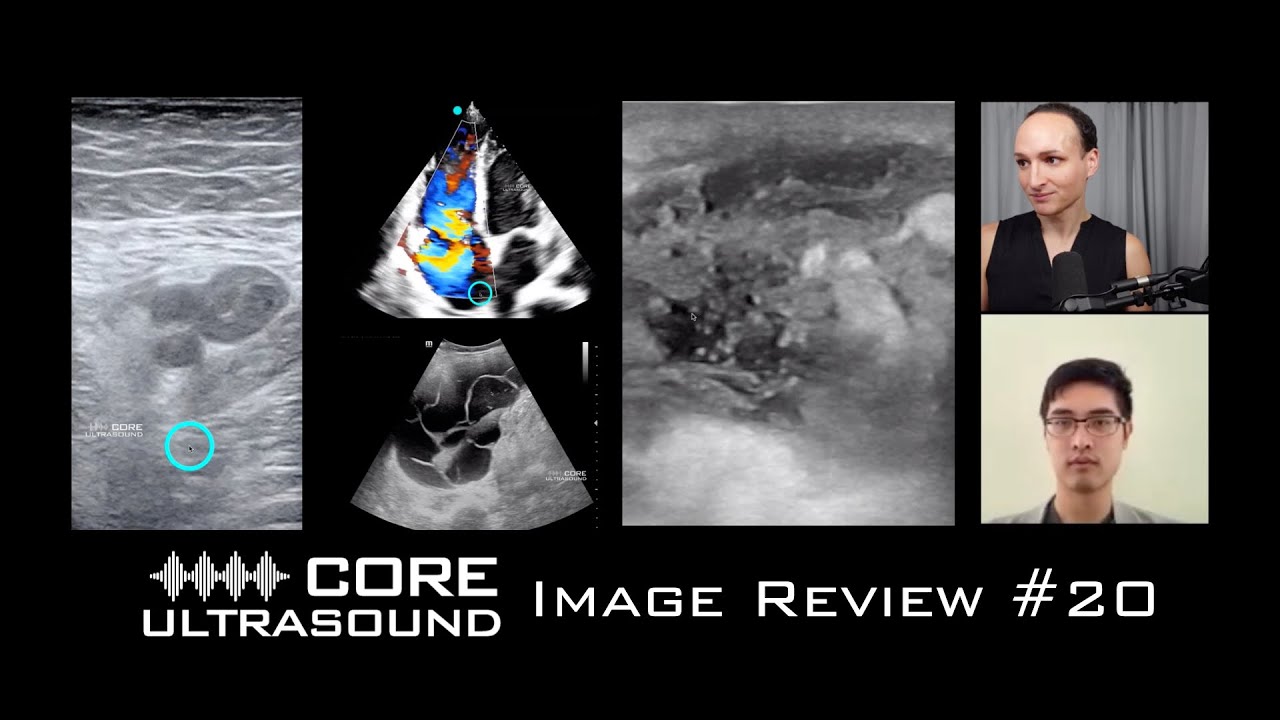 Core Ultrasound Image Review, Episode 20! - YouTube