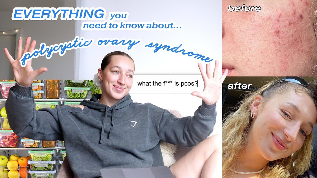 how I healed my PCOS (no more acne, managing my diet & exercise) - YouTube