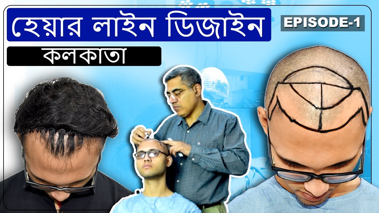 Hair Transplant in Kolkata | Hair Line Design | Receding Hair Line ...