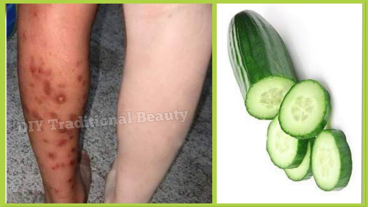 How to get rid of Dark spots, Scar, Mosquito Bites, Hyperpigmentation ...