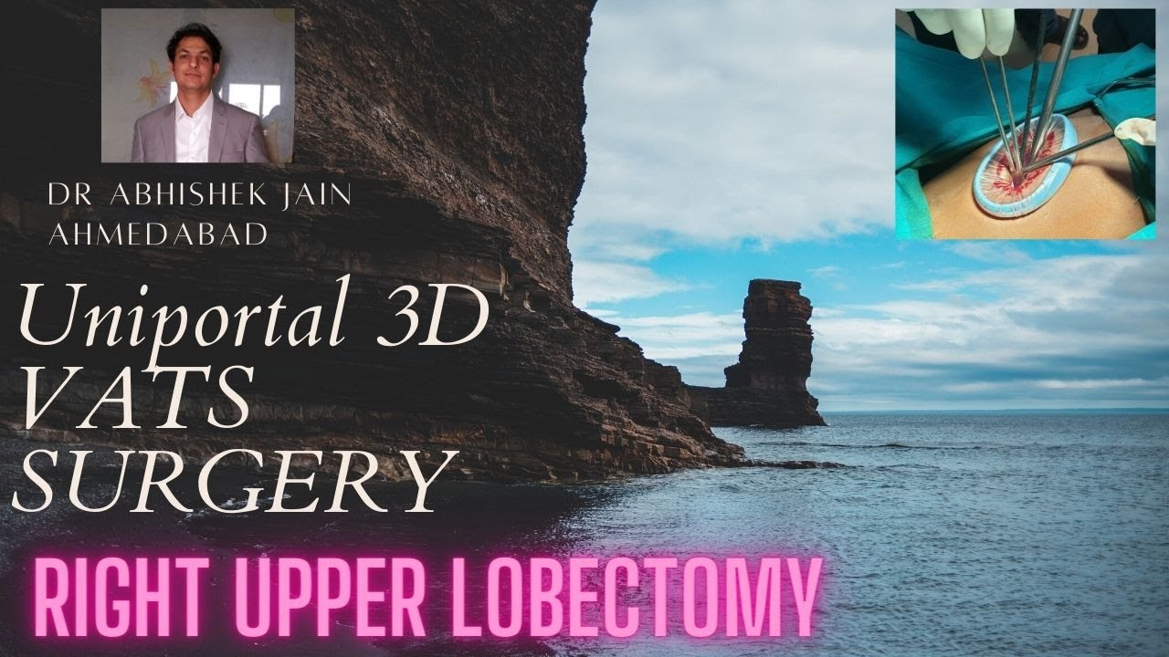 Uniportal 3D VATS Right Upper lobectomy - FISSURELESS TECHNIQUE - YouTube