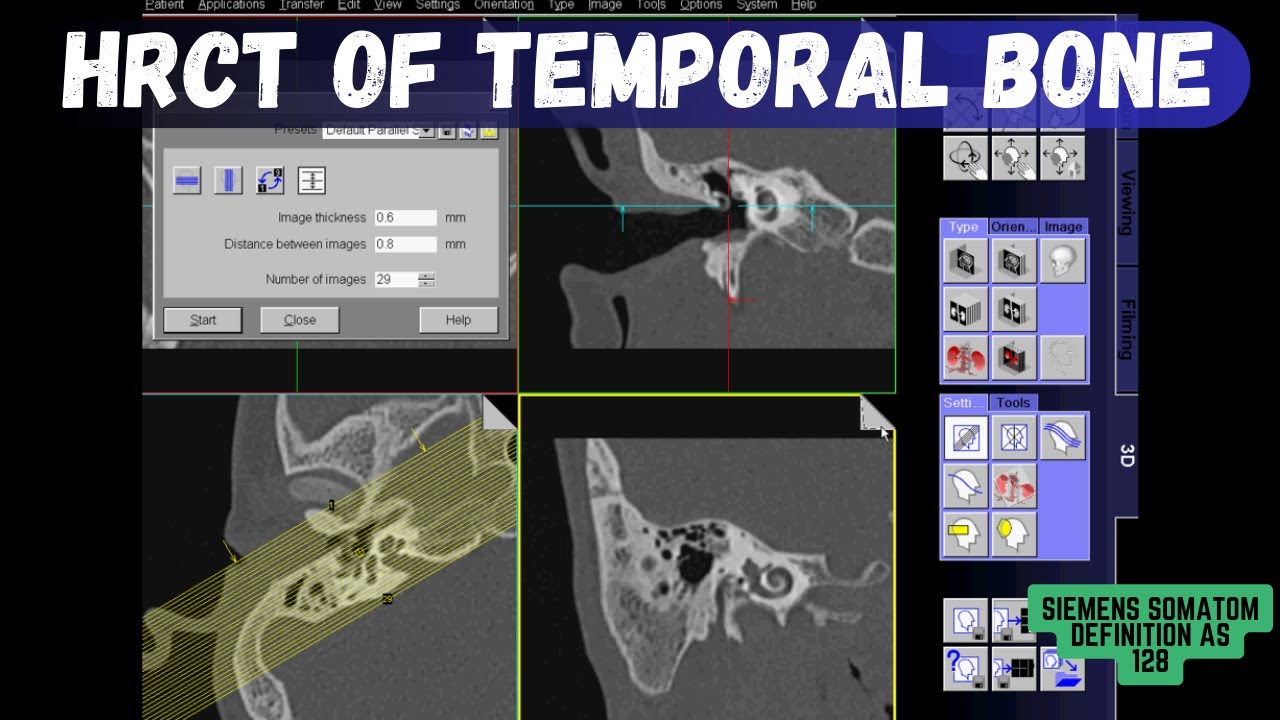 HRCT Temporal Bone/EAR/Mastoid/IAC Technique | Patient positioning ...