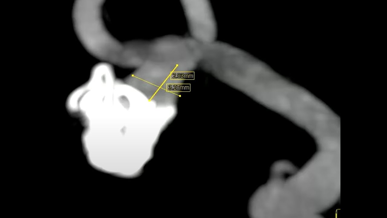 LIVE - Acom coil compaction, stent+coil - YouTube