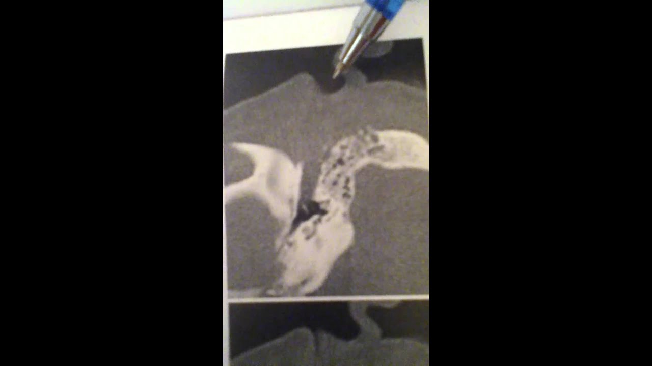 MALIGNANT OTITIS EXTERNA - CT FINDINGS - YouTube