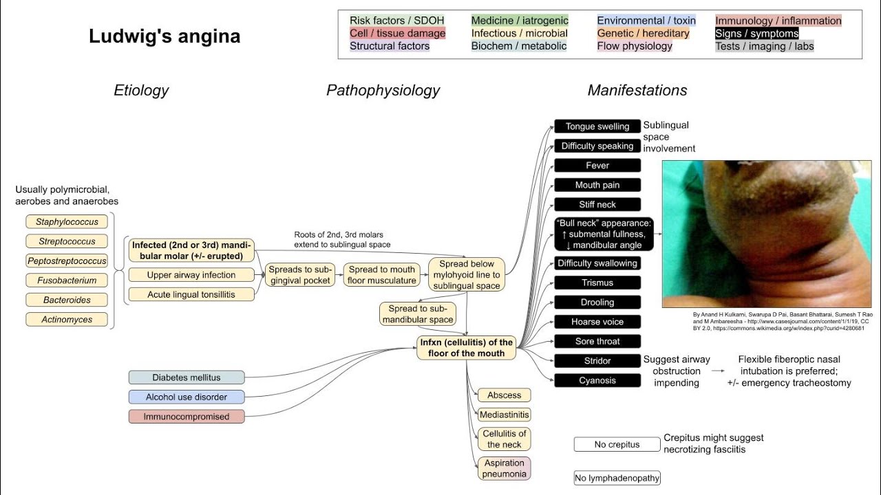 Ludwig's angina (mechanism of disease) - YouTube