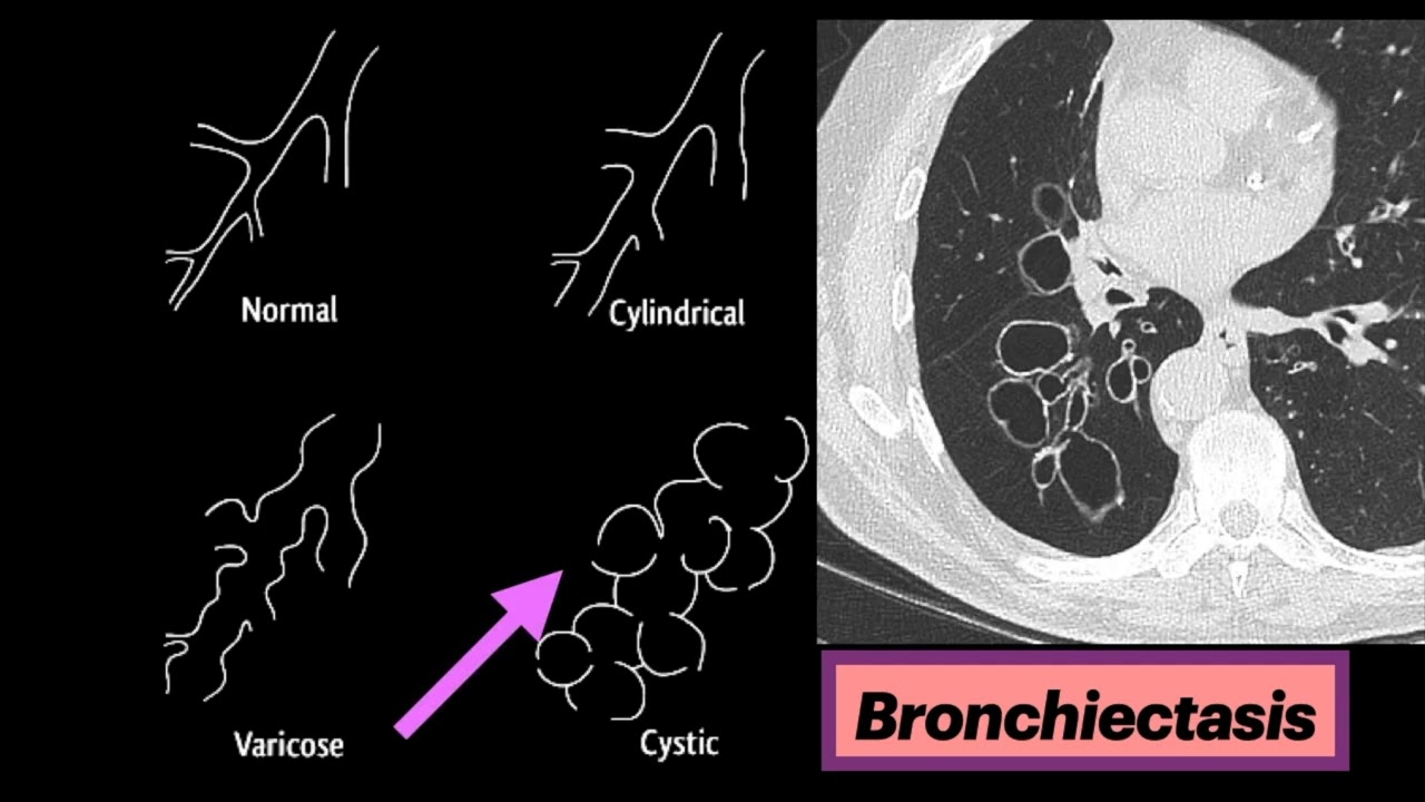 Types Of Bronchiectasis