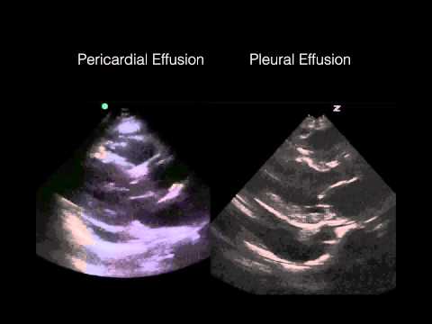 Cardiac Ultrasound Pericardial vs Pleural effusion - YouTube
