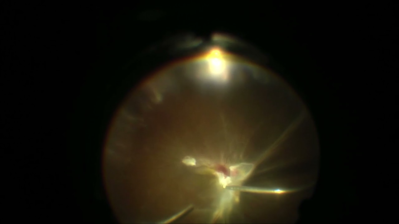 Advanced traction retinal detachment repair in a patient with ...