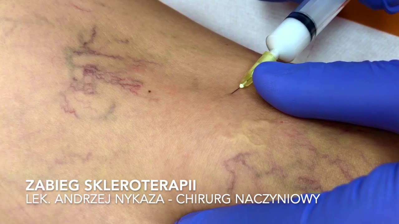 Skleroterapia Centrum Medyczne OrtoGo Lek. Andrzej Nykaza - YouTube