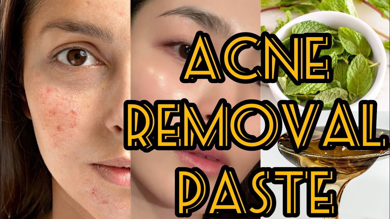 Acne Removal Paste||Two Steps Remedy||Homemade Remedies - YouTube
