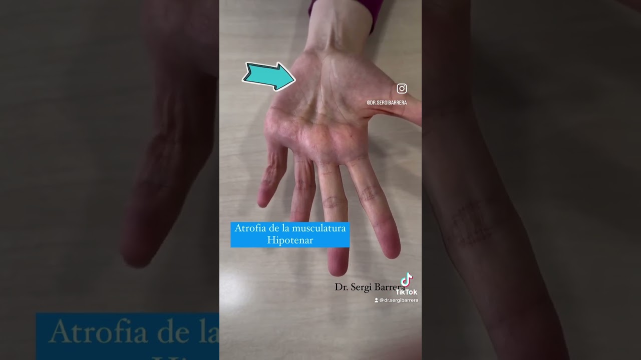 Nervio Cubital Mano En Garra