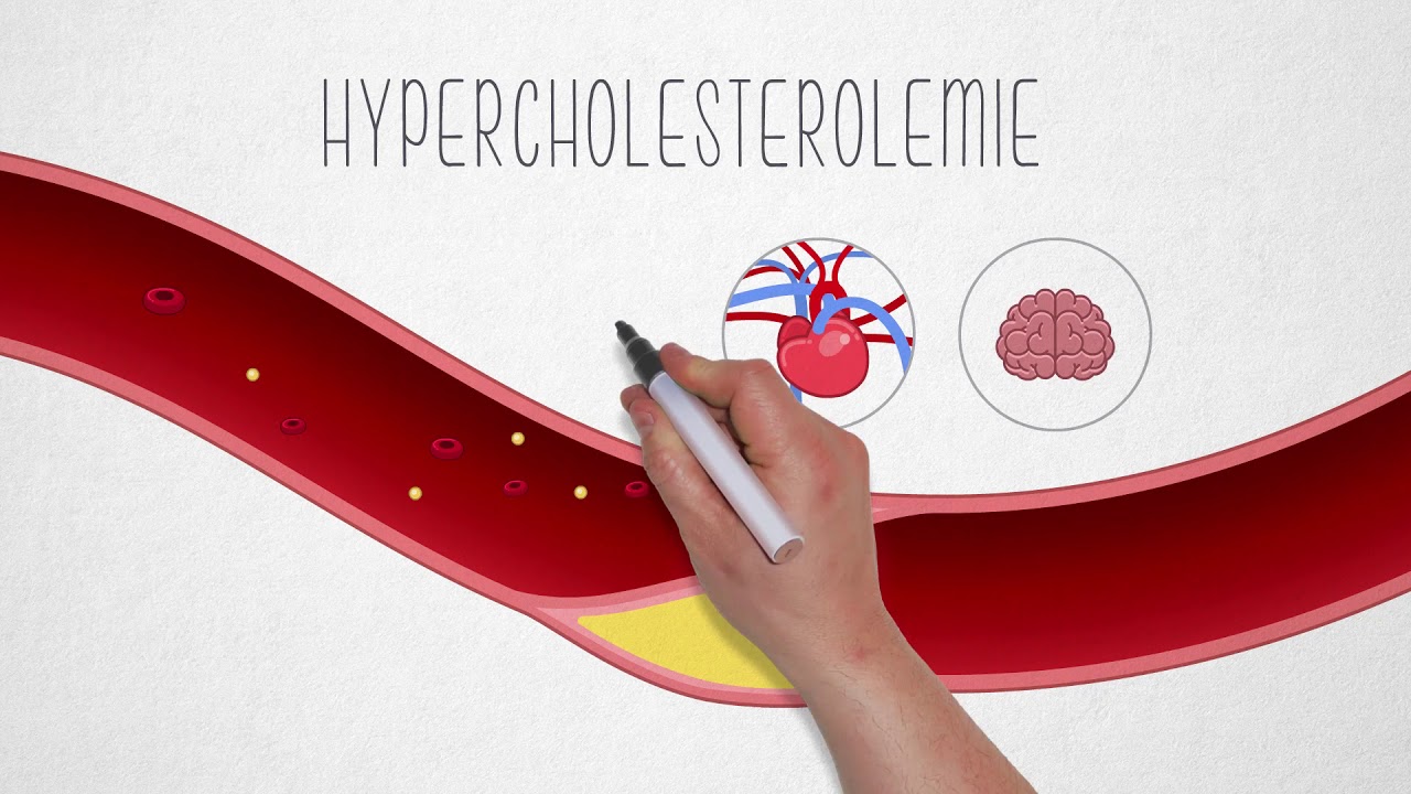 Slagaderverkalking - atherosclerose - YouTube