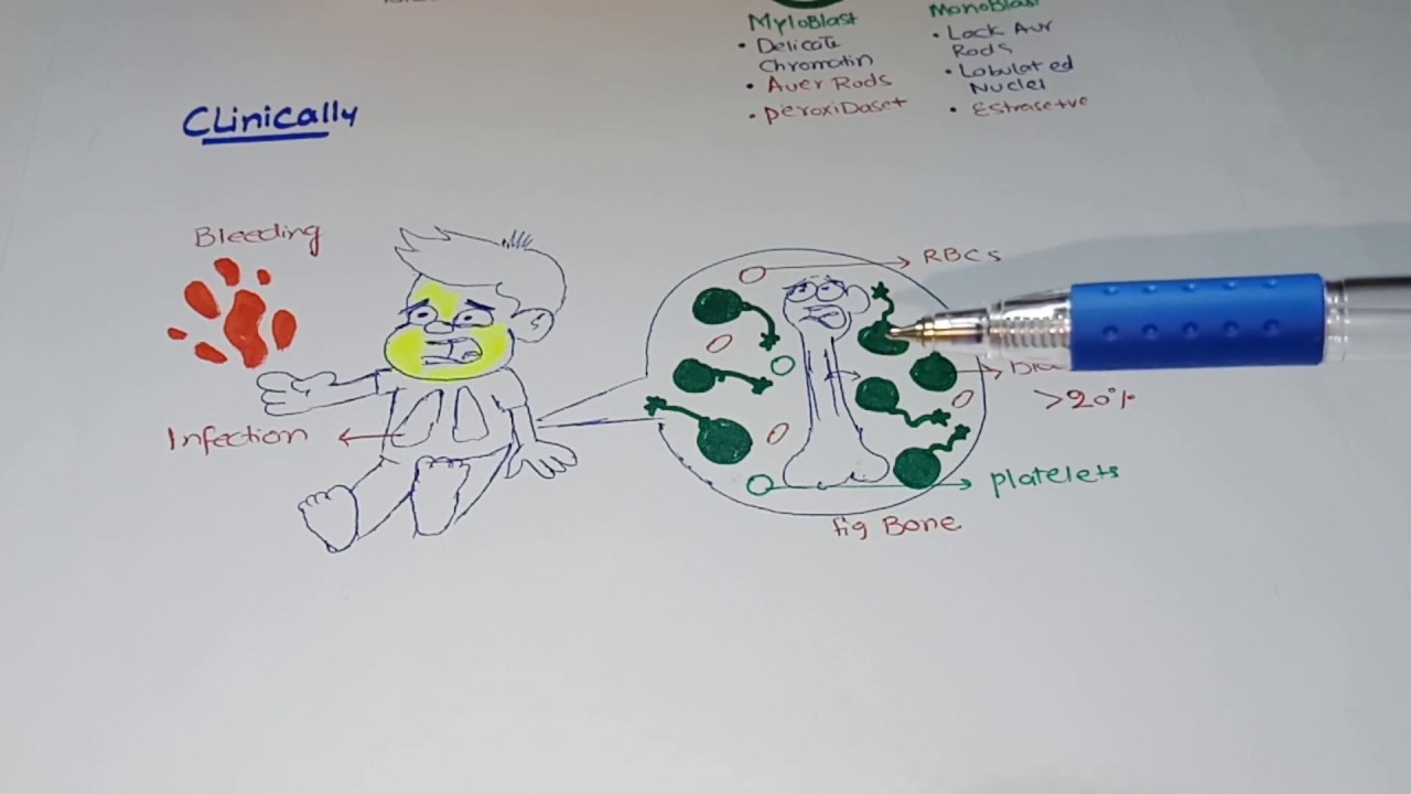 Myleoid neoplasm/ Acute myeloid leukemia/ mylodysplastic syndrome ...