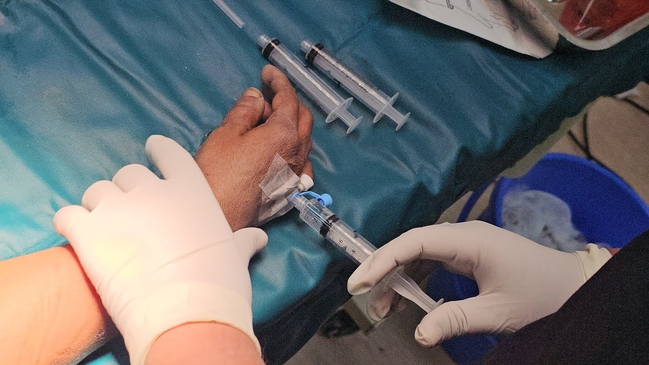 Bier's block procedure#anesthesia #IVRA#block - YouTube