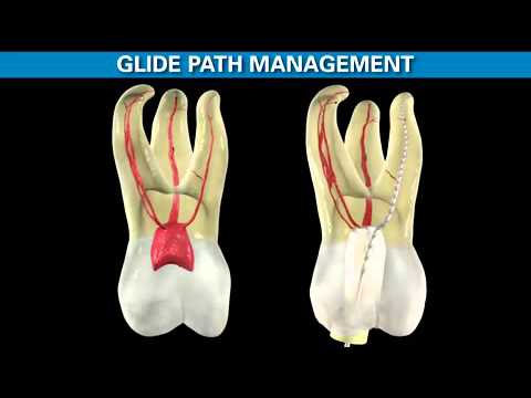 ProTaper Gold - Shaping the Future of Endodontics | Dentsply Sirona ...